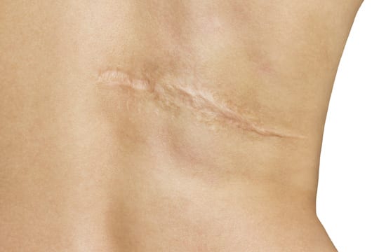 Je littekens geven klachten of zijn erg zichtbaar? Gebruik BAPSCARCARE