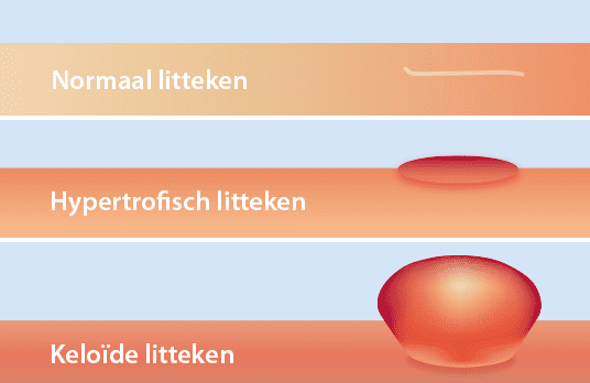 Je litteken verminderen, hoe doe je dat? - BAPSCARCARE