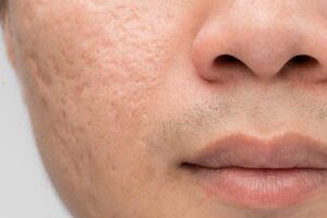 Verschillende soorten littekens - BAPSCARCARE