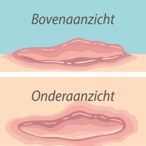 BAPSCARCARE ondersteunt het herstel van littekens